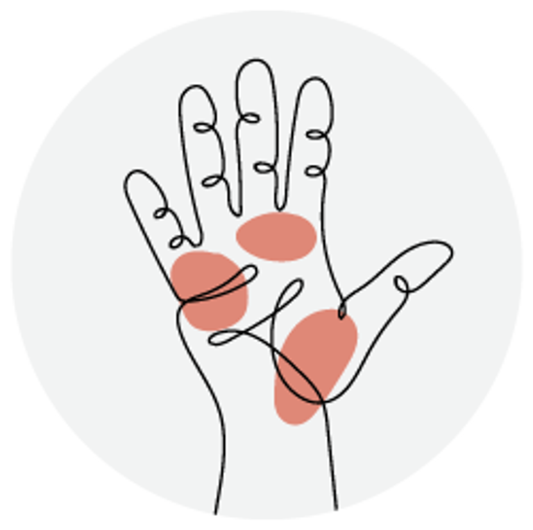 Treatment for Poison Ivy Exposure